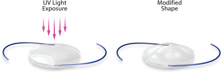 What Are Light Adjustable Lenses and How Do They Work?